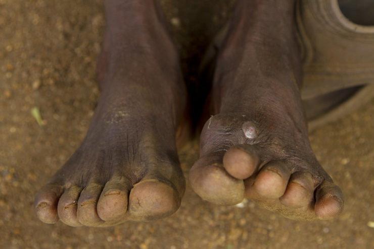 Guinea Worm Nearly Eradicated, But Push for Zero Cases Will Require ...